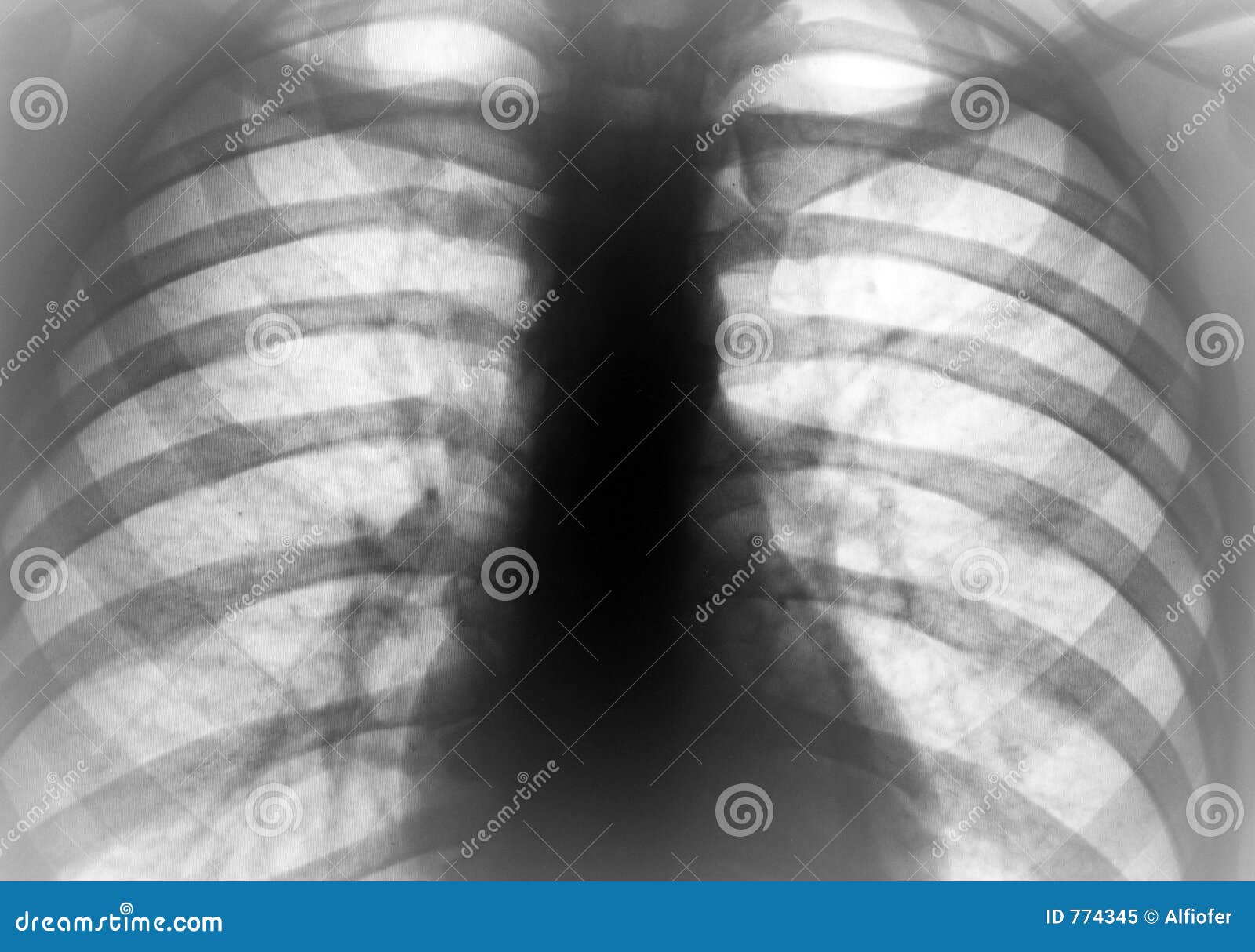 Spinal Anaesthesia Royalty-Free Stock Photography | CartoonDealer.com ...