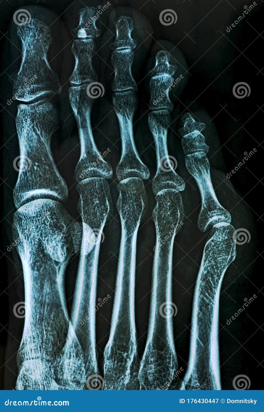 X-ray of the Bones of the Toes Stock Image - Image of film, examination ...