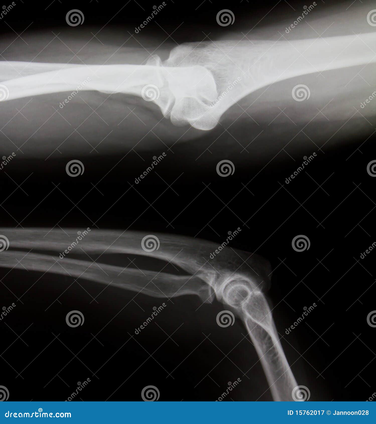X-ray of Both Elbow of Human Stock Image - Image of healthcare, body ...