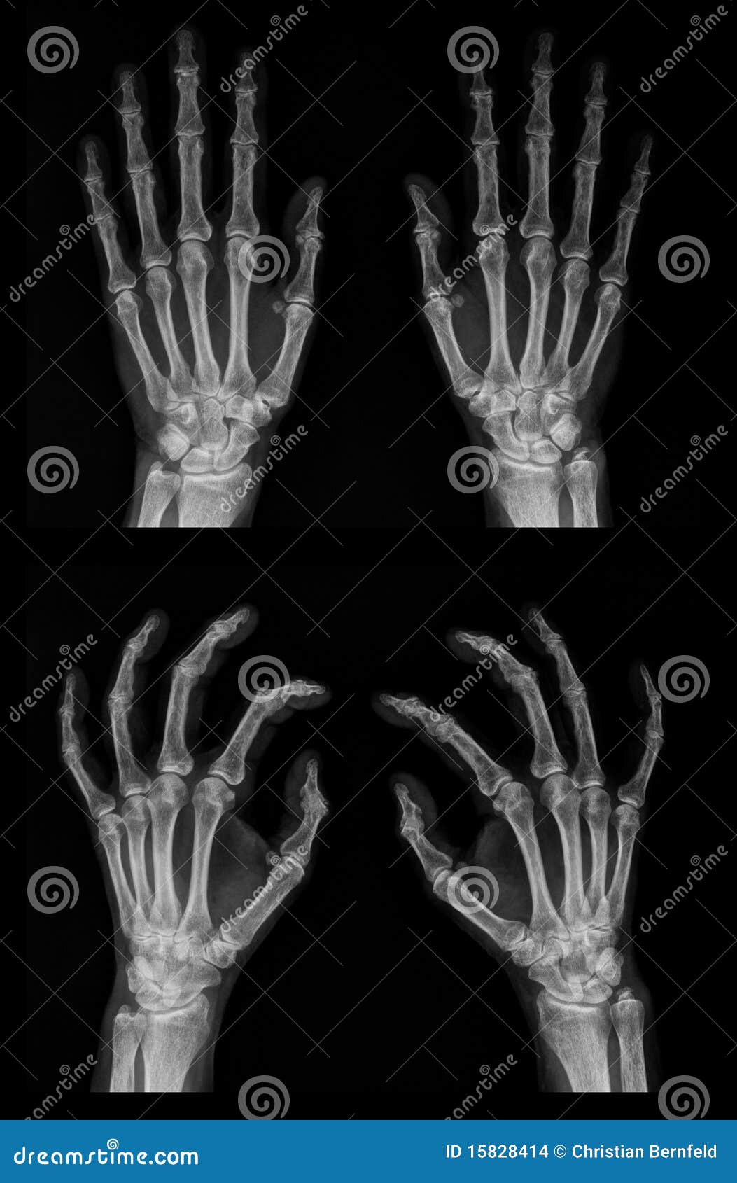 X-ray of both hands stock photo. Image of fingers, diagnostic - 15828414