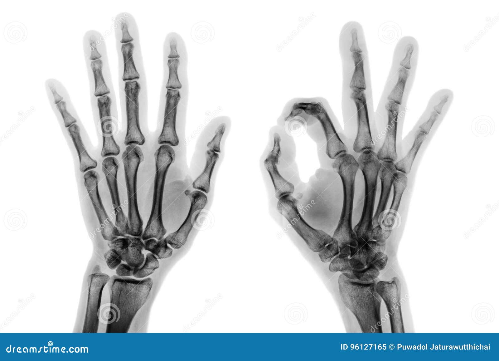 X-ray Both Hands with OK Sign Stock Image - Image of medicine, finger ...