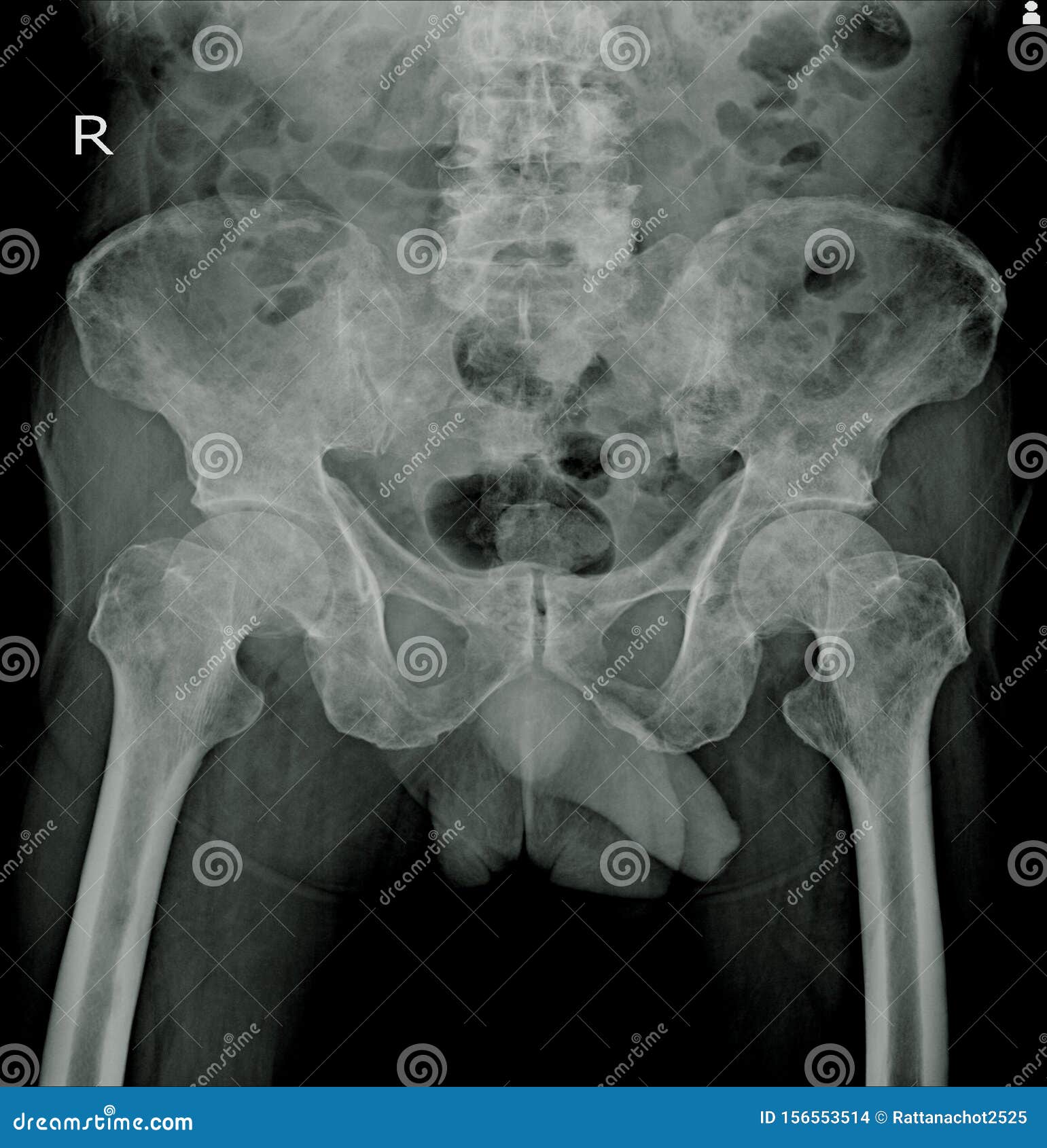X-ray Both Hip Impression: Multiple Bone Metastasis Stock Photo - Image ...