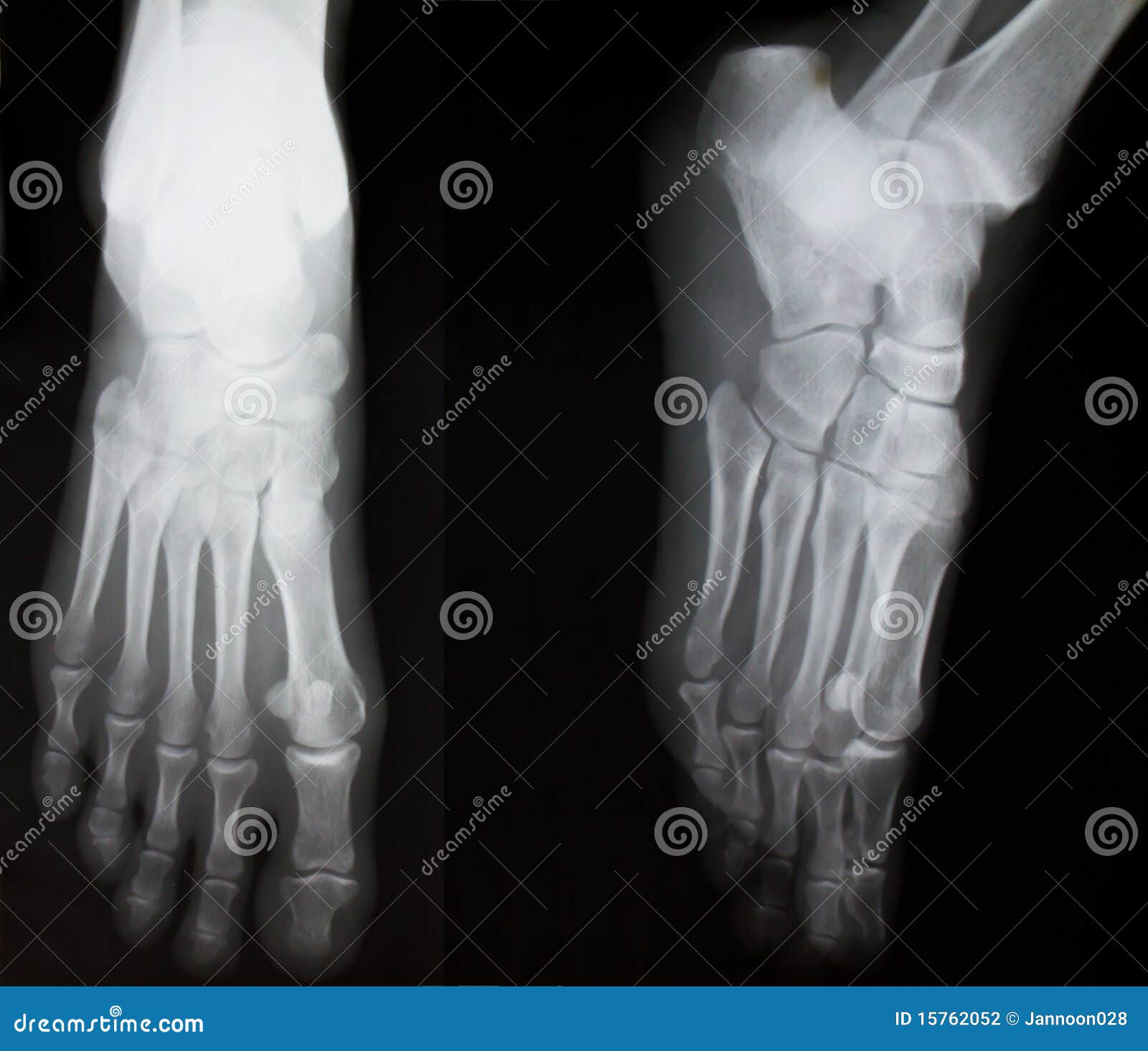 X-ray of both human feet. stock photo. Image of joint - 15762052