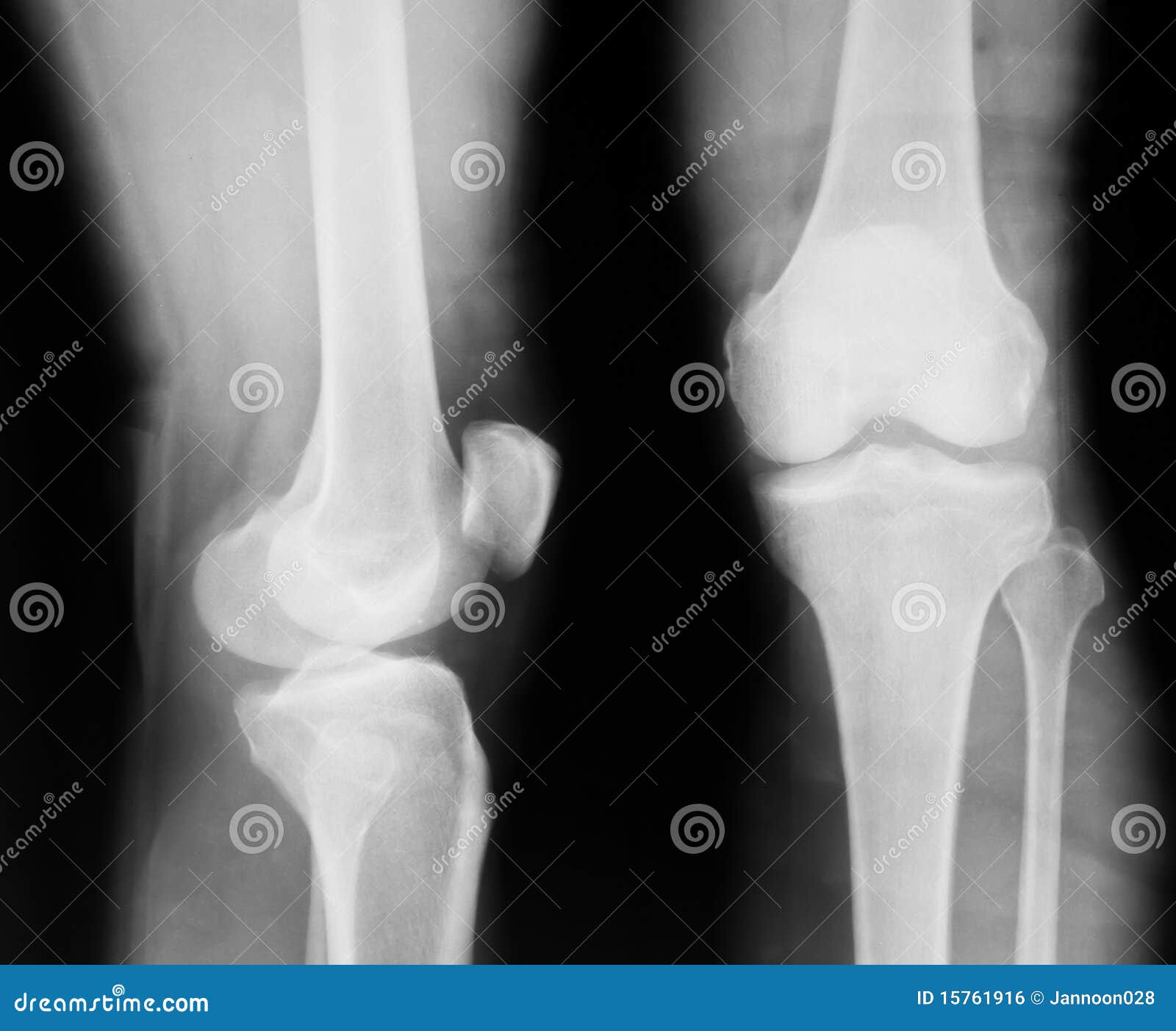 X-ray Human Knee Joints Finding Fracture Proximal Metaphysis Of Tibia ...