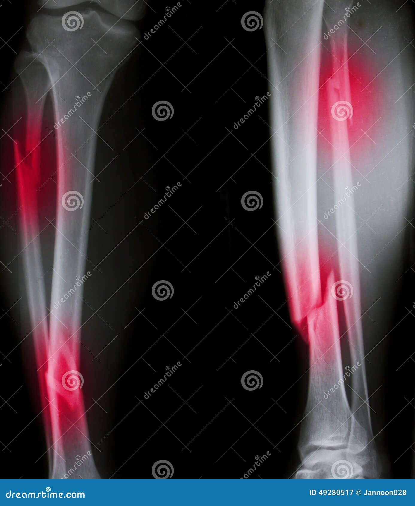 Legs Of A Man With A Broken Leg On A Blue Background. X-ray Image Of ...
