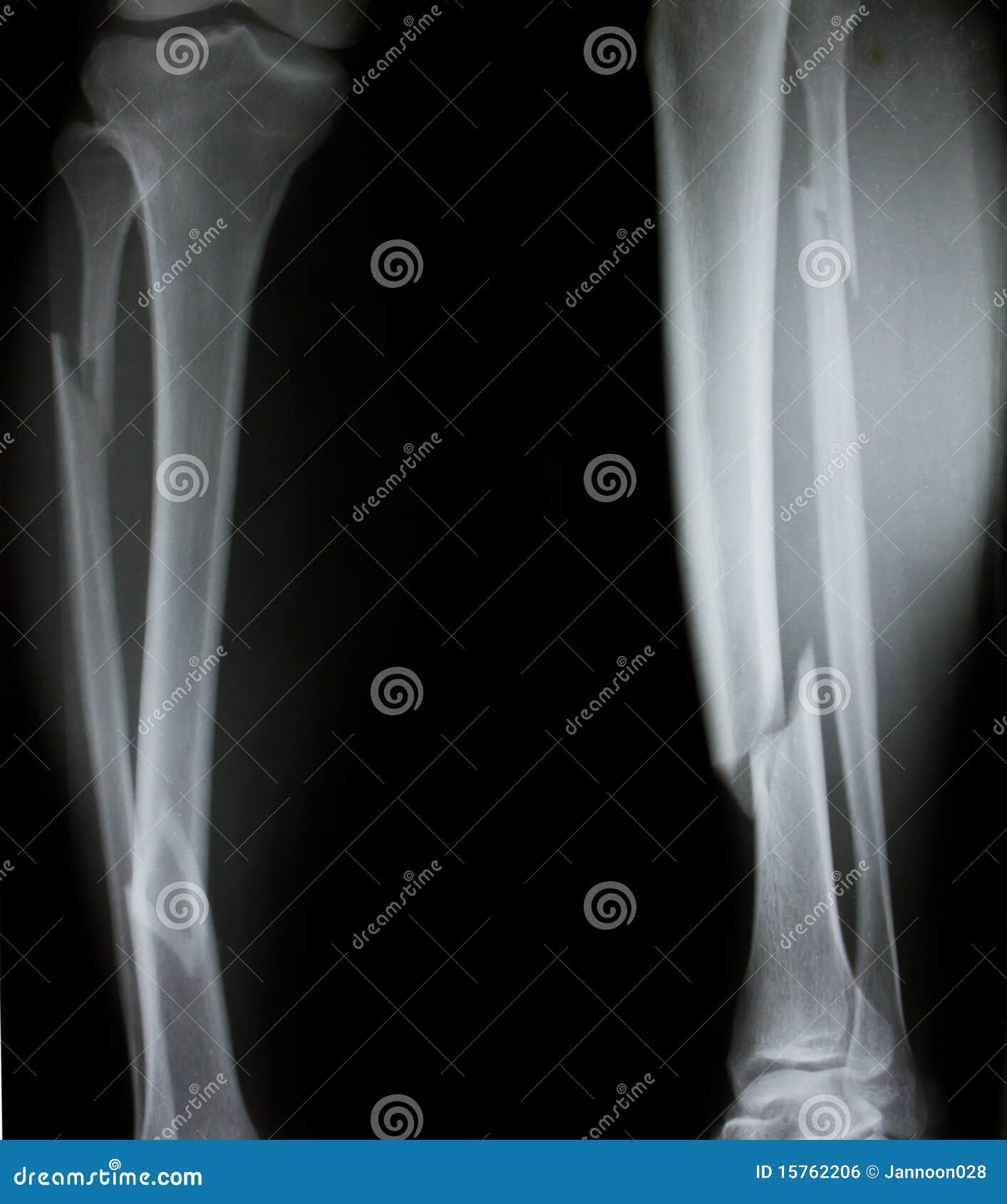 Xray Broken Leg