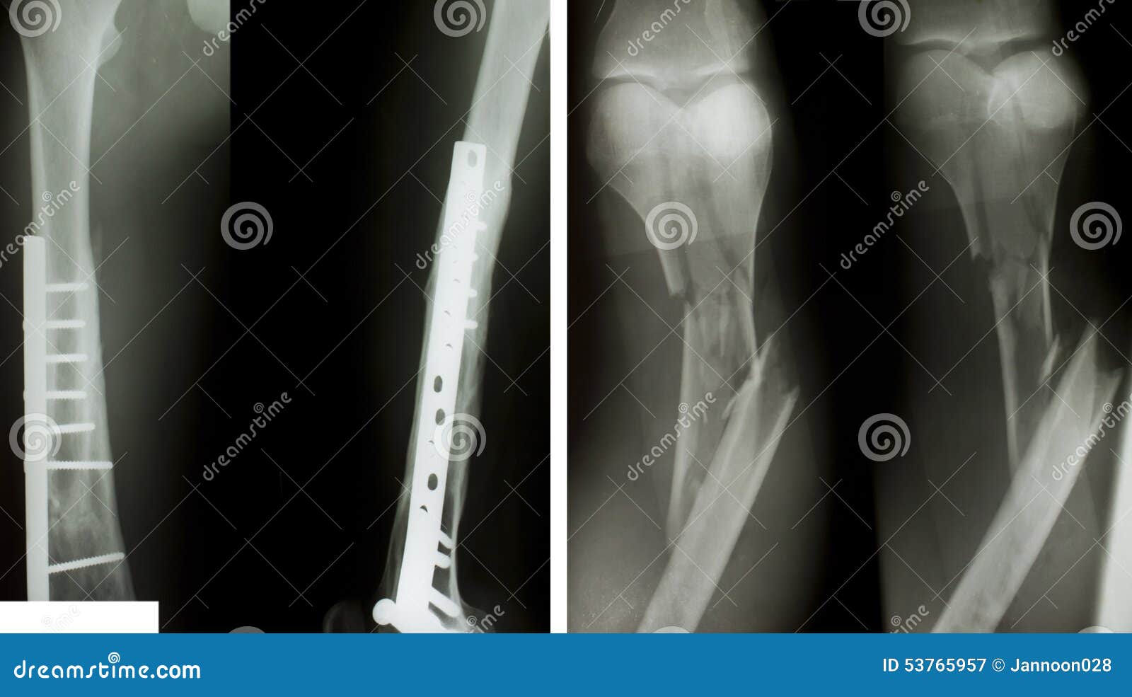 X-ray of both human legs stock image. Image of film, disease - 53765957