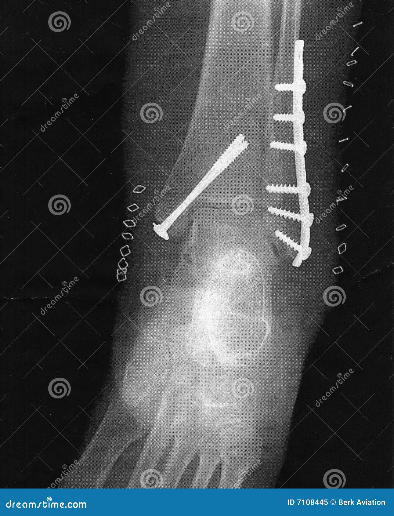 X Ray Broken Ankle