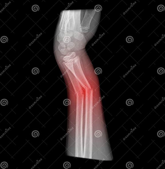 X-ray of broken arm stock image. Image of medicine, healthcare - 14031569