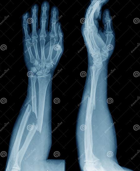 X-ray of broken arm stock photo. Image of condition, cast - 47702962