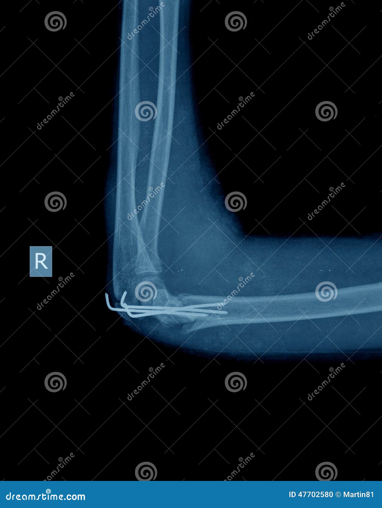X-ray of broken arm with stock photo. Image of injury - 47702580
