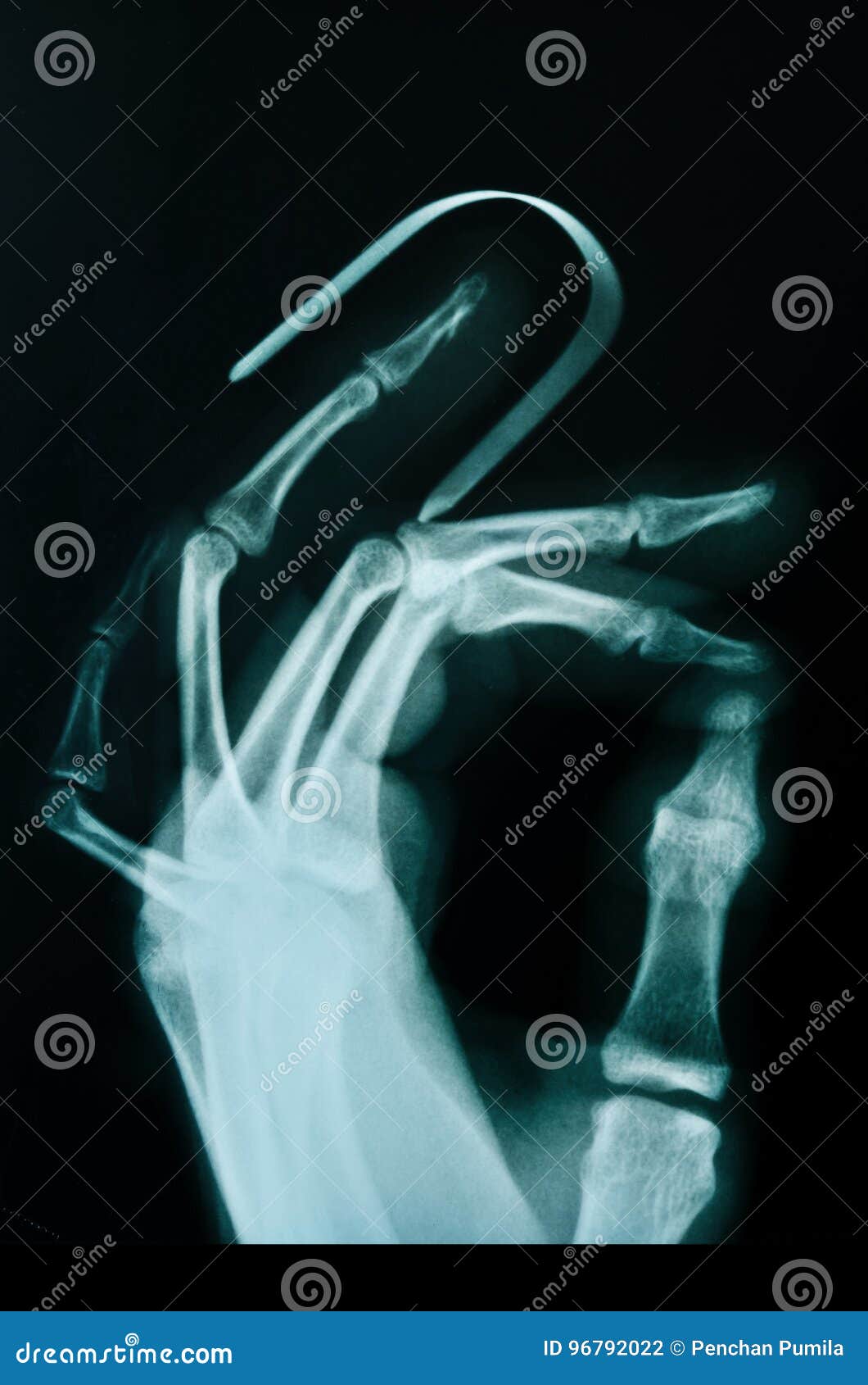 X-ray of broken finger. stock photo. Image of malformation - 96792022