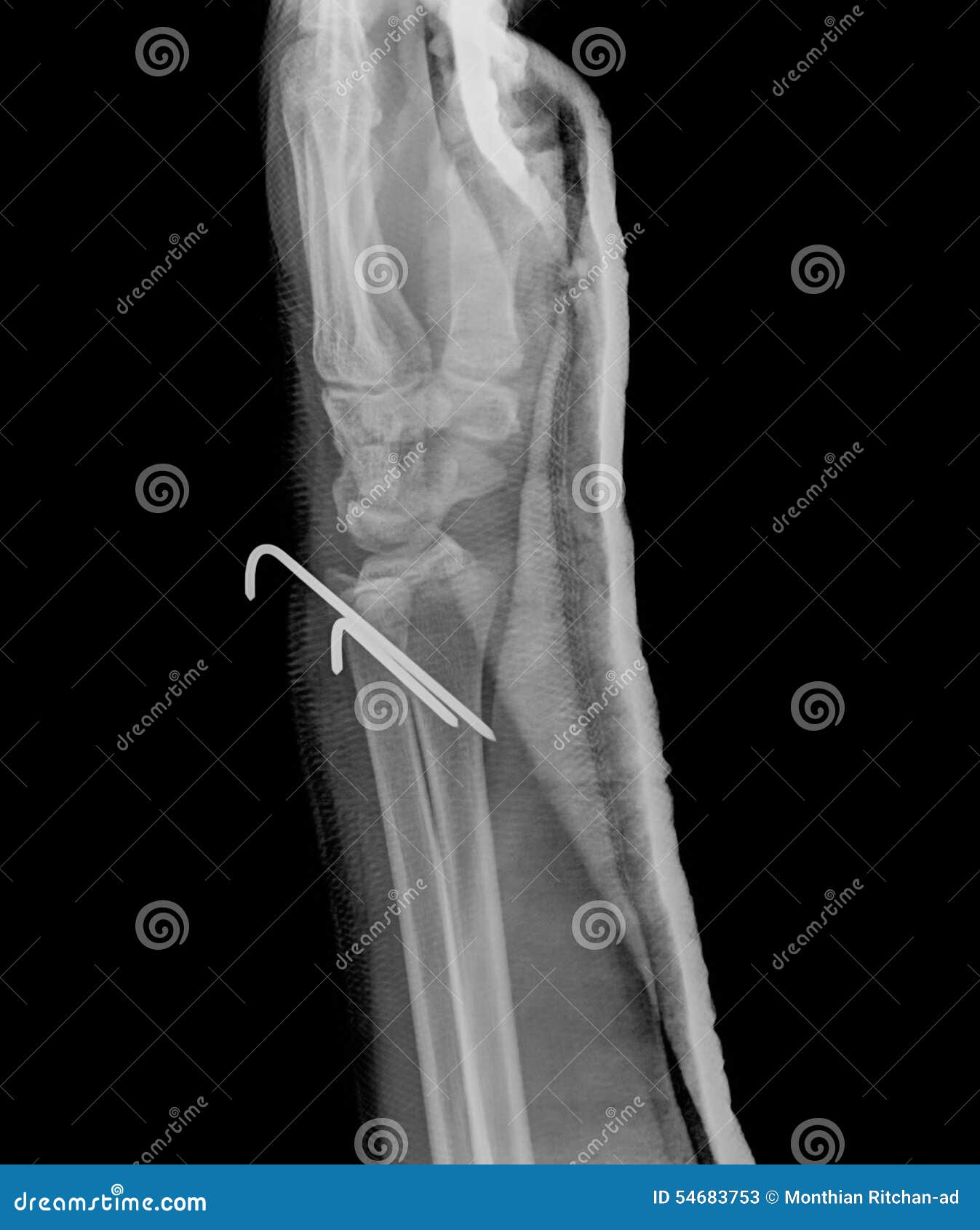 Xray Broken Hand