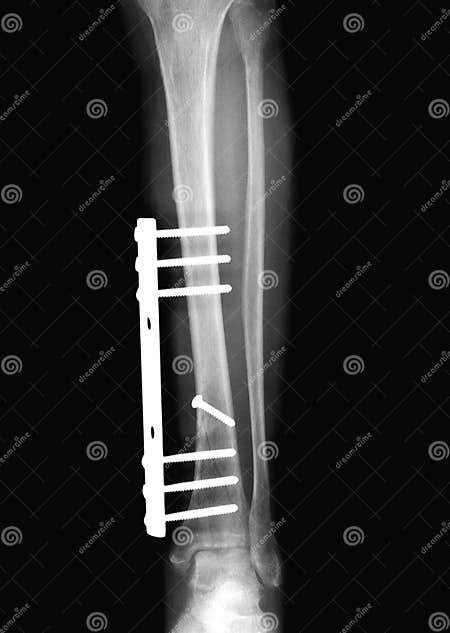 X-ray of the broken leg stock image. Image of radiology - 20147835