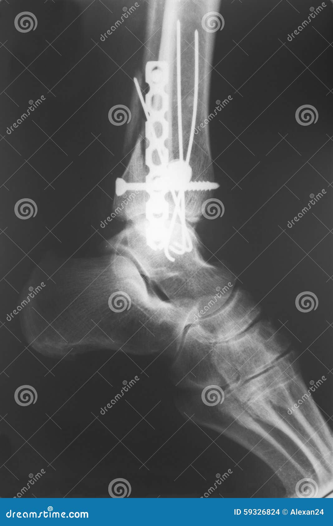 Xray Image Of Broken Leg Ap And Lateral View Stock