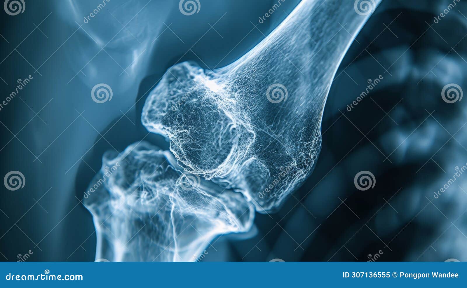 X-ray of a Broken Upper Arm with Bone Fragments and Displacement Stock ...