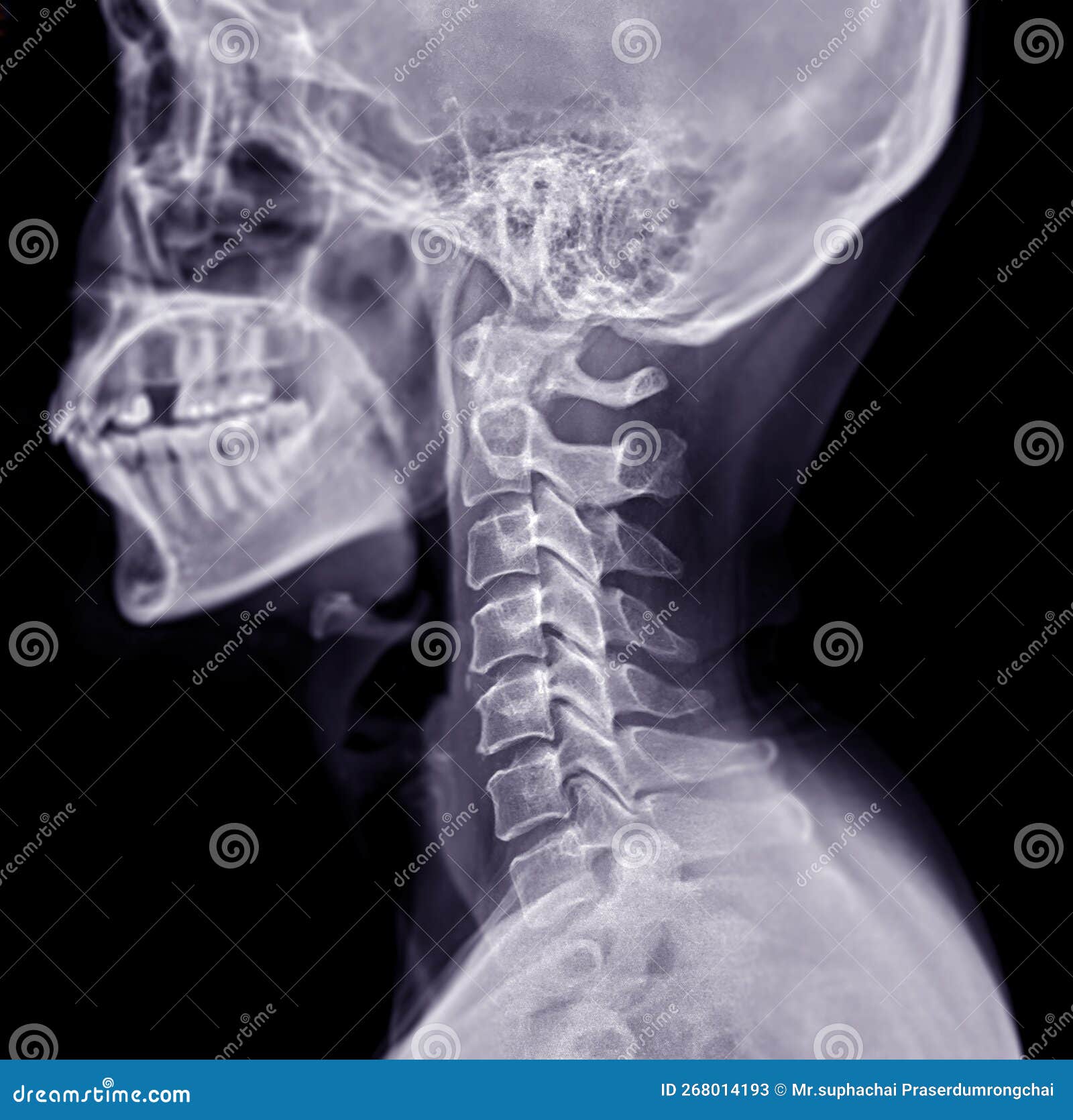 X-ray C-spine or X-ray Image of Cervical Spine Lateral View for ...