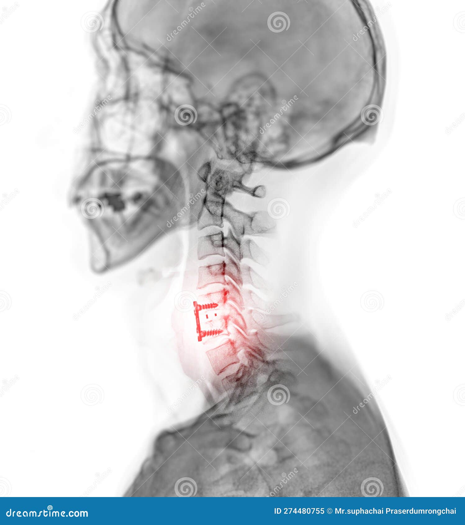 X-ray C-spine or X-ray Image of Cervical Spine Lateral View Showing ...