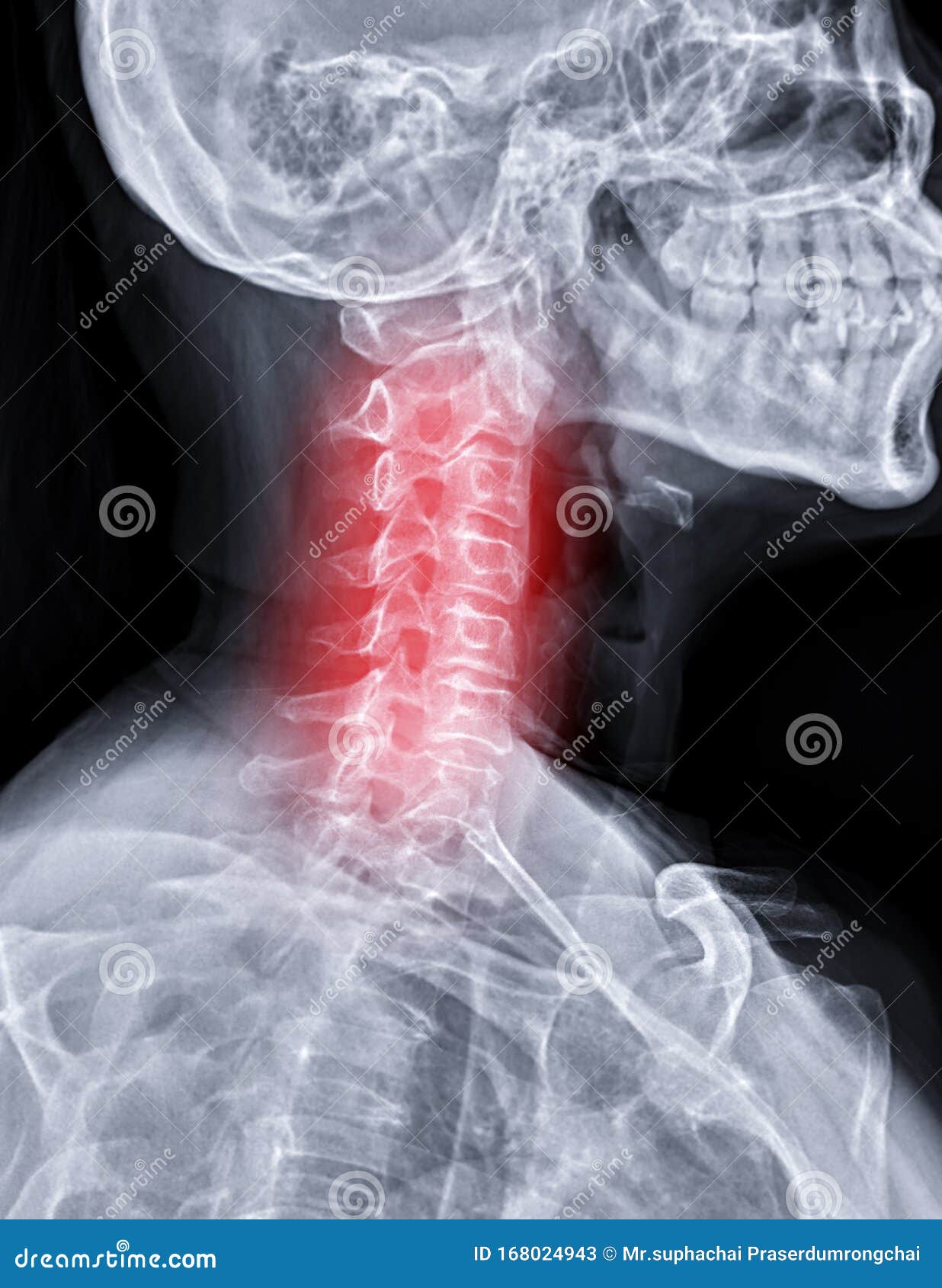 X-ray C-spine Or X-ray Image Of Cervical Spine AP View Stock ... X-ray C-spine Or X-ray Image Of Cervical Spine AP View Stock ...