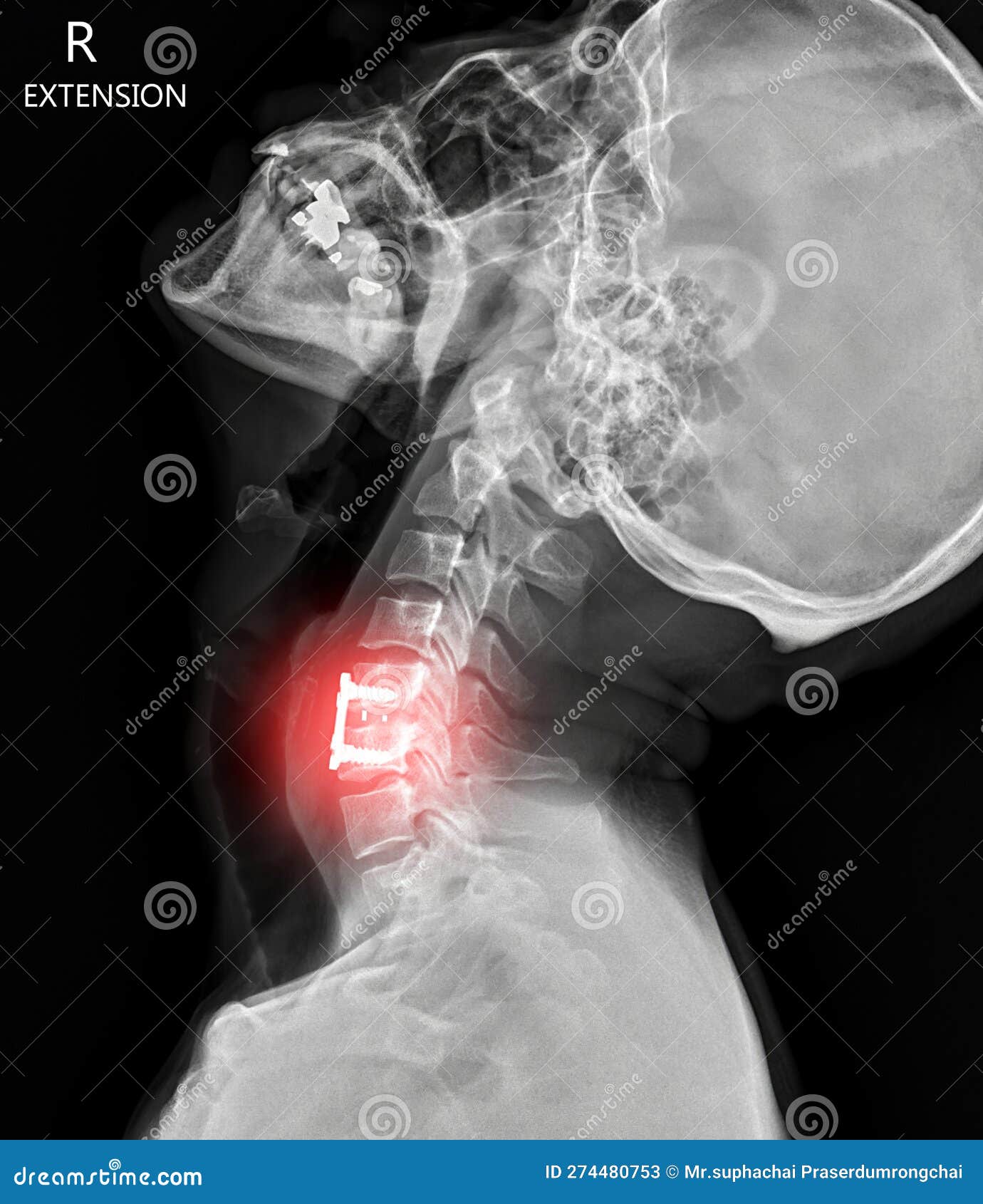 Adenoid X Ray