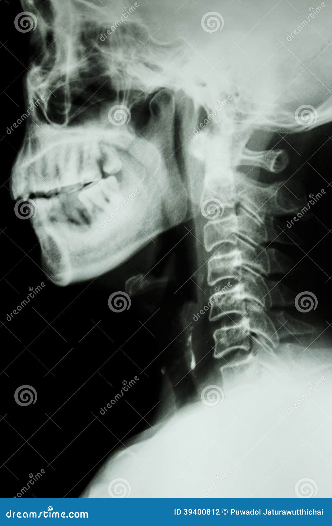 Peritonsillar Abscess X Ray