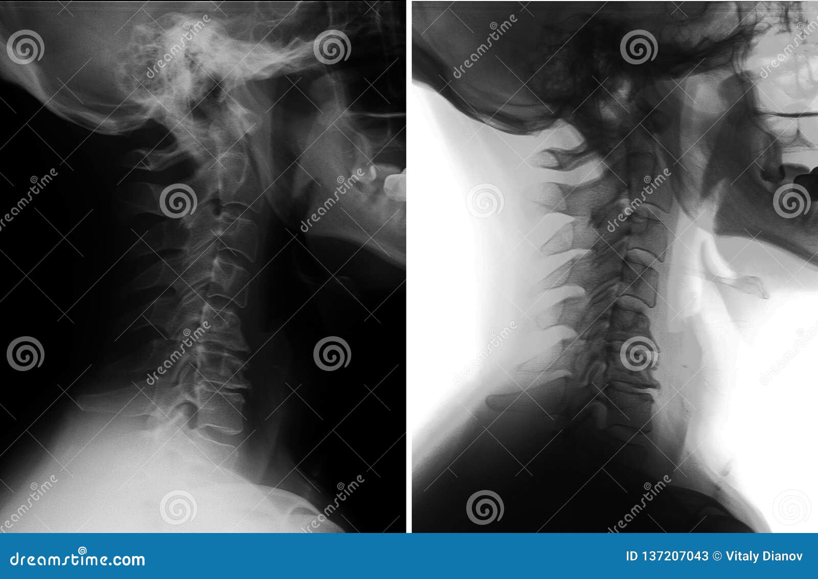 X-ray of the Cervical Spine. Spondylosis, Osteochondrosis. Cervical ...