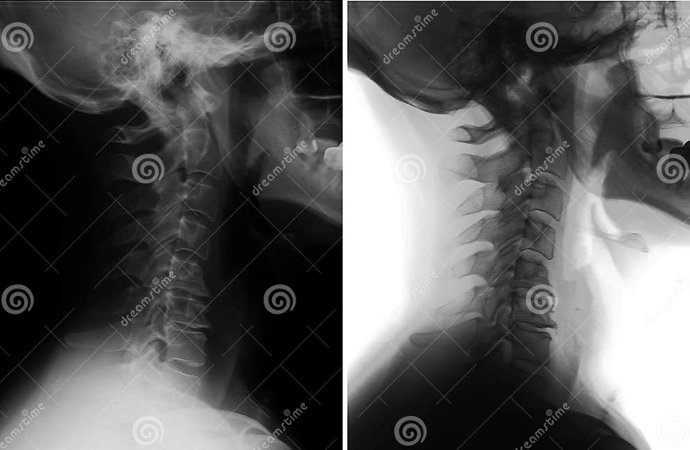X-ray of the Cervical Spine. Spondylosis, Osteochondrosis. Cervical ...