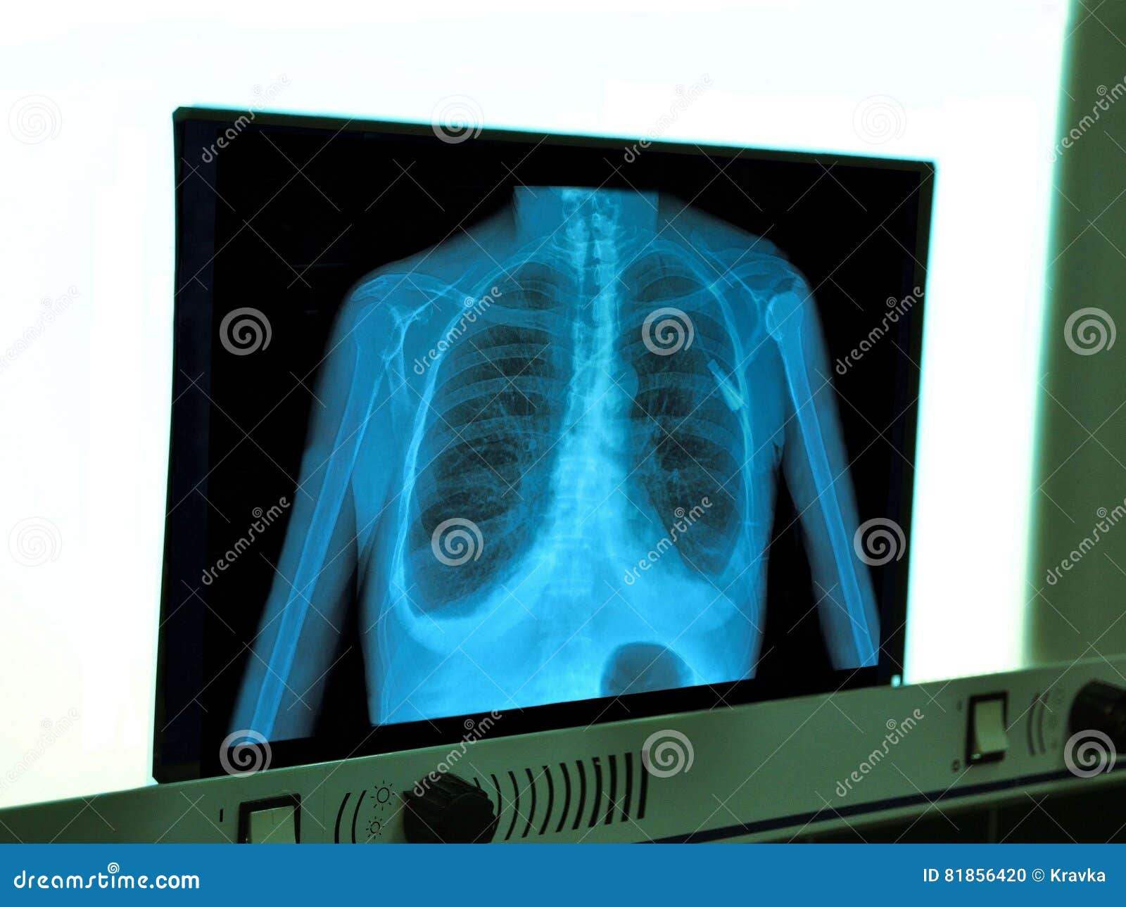 X-ray of Chest Heart Stimulator Stock Photo - Image of ribs, medicine ...