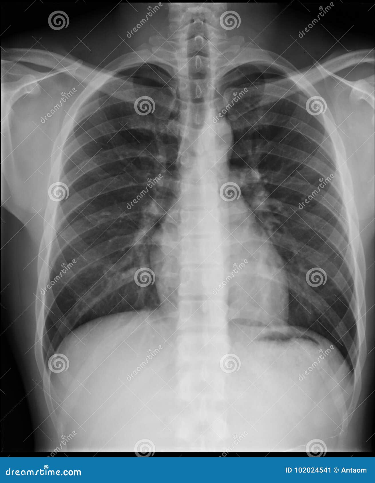 X ray chest pa upright. stock image. Image of patient - 102024541