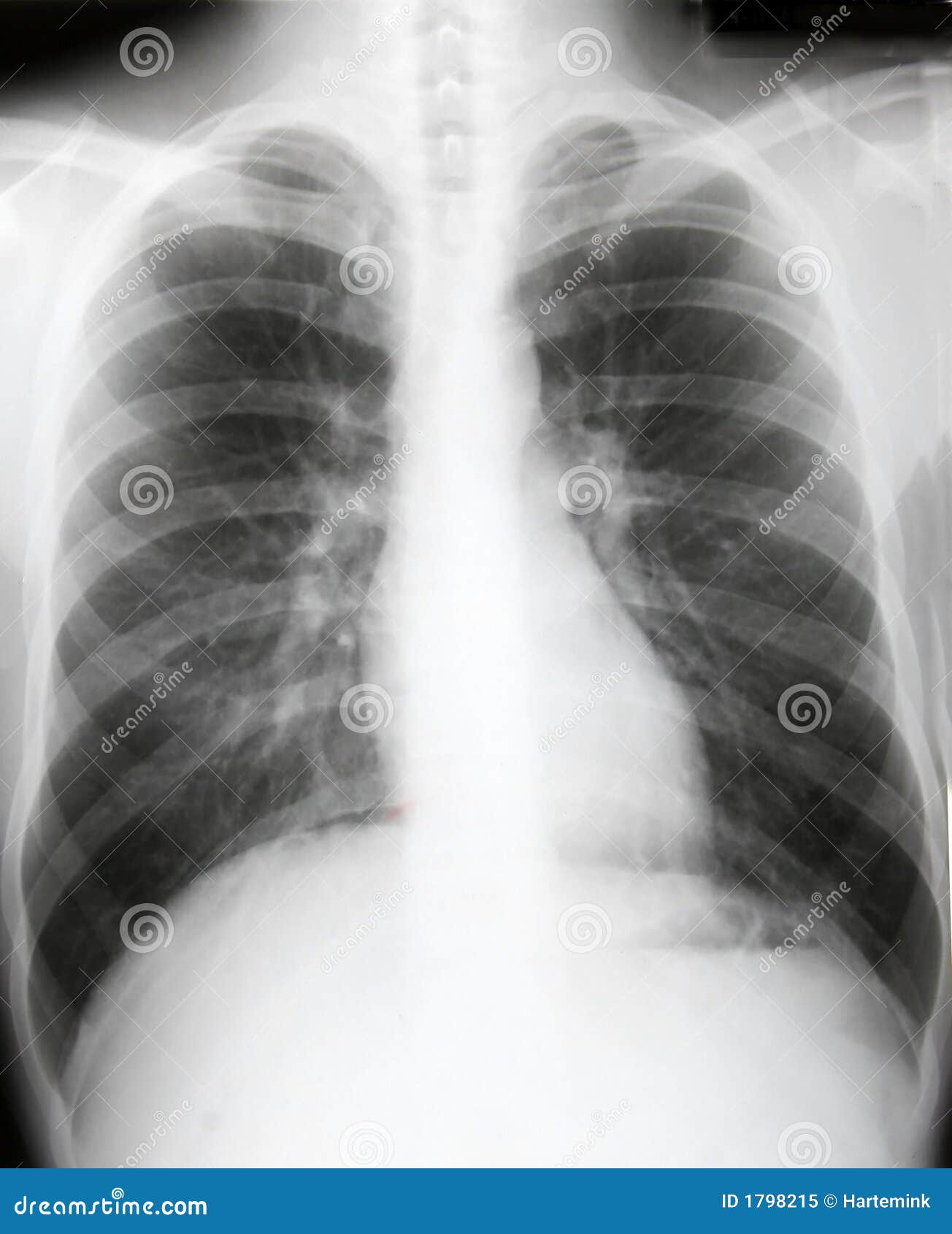 X-ray of chest of patient stock image. Image of clinic - 1798215