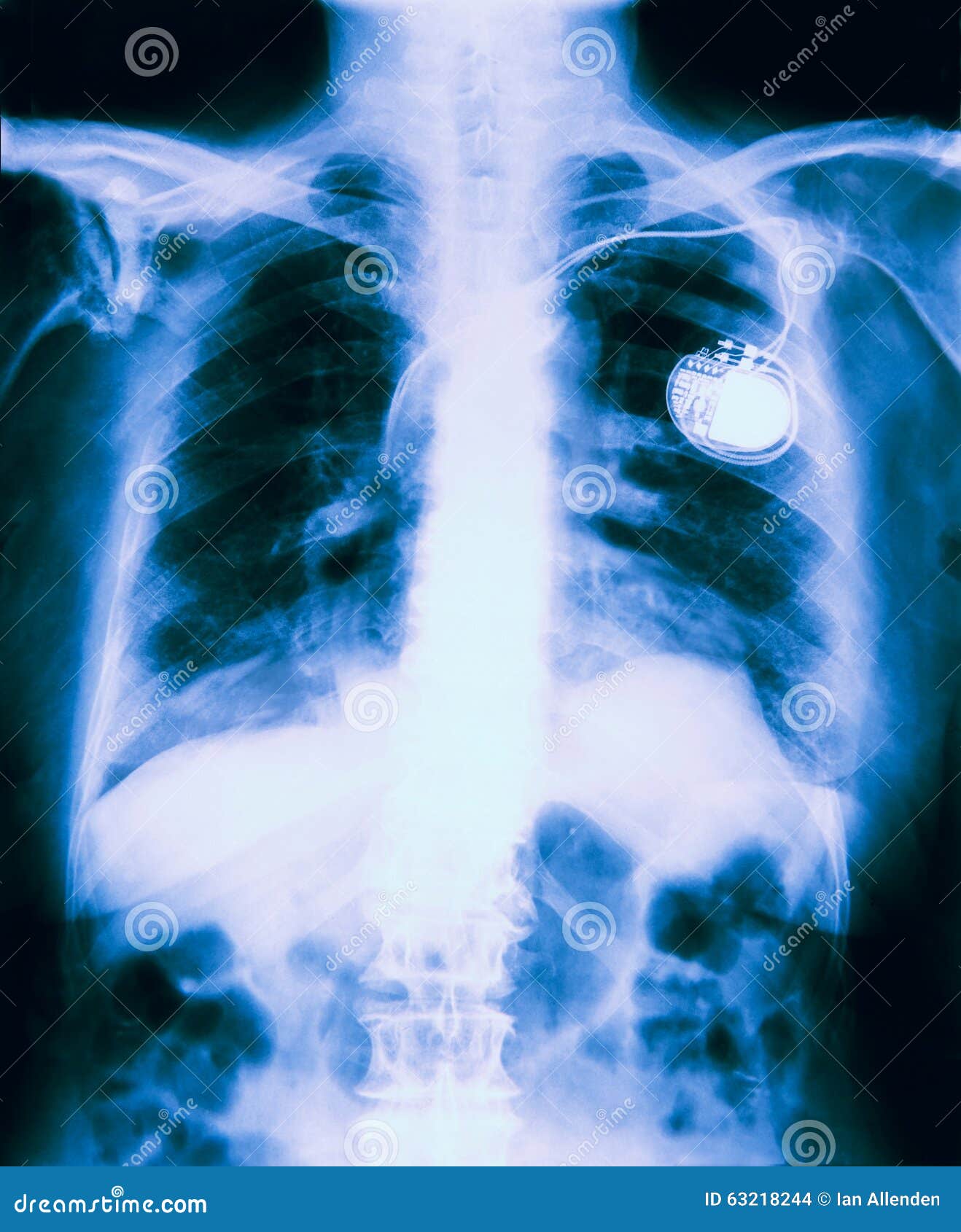 X Ray of Chest Showing Pacemaker Fitted Stock Photo - Image of ...