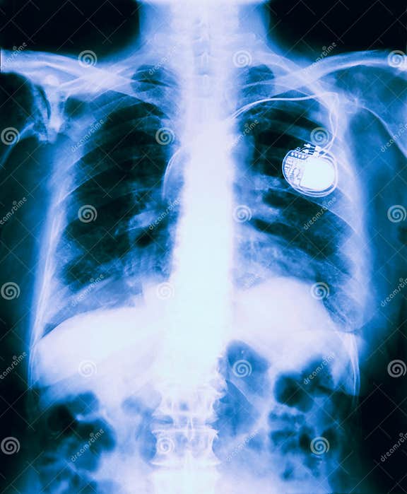 X Ray of Chest Showing Pacemaker Fitted Stock Photo - Image of ...