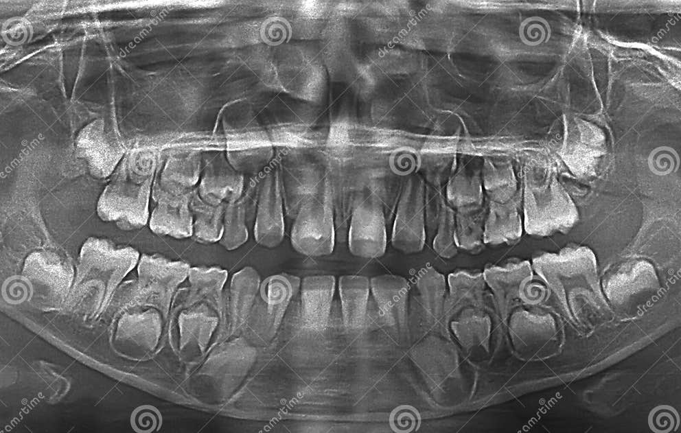 X ray of child teeth stock photo. Image of dentistry - 76618006