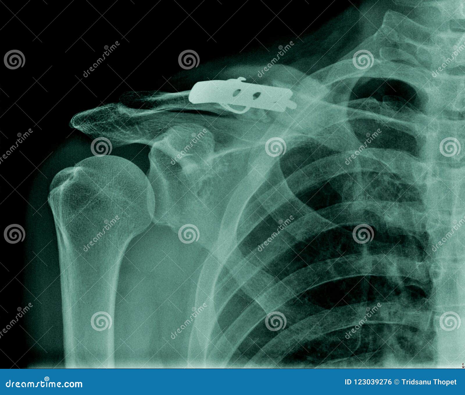 Clavicle Fracture With Broken Collarbone Vector Illustration. Medical ...