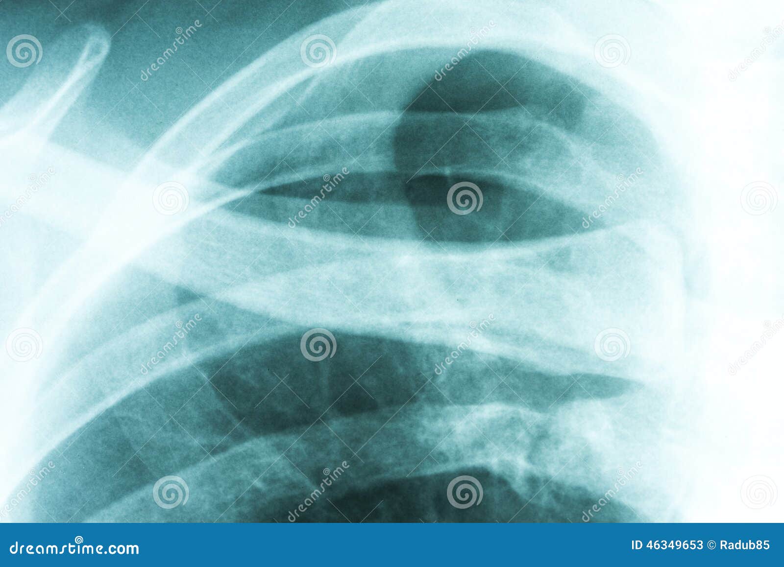 Clavicle Collar Bone , Scapula Shoulder Blade , Humerus, Ulna, Radius ...