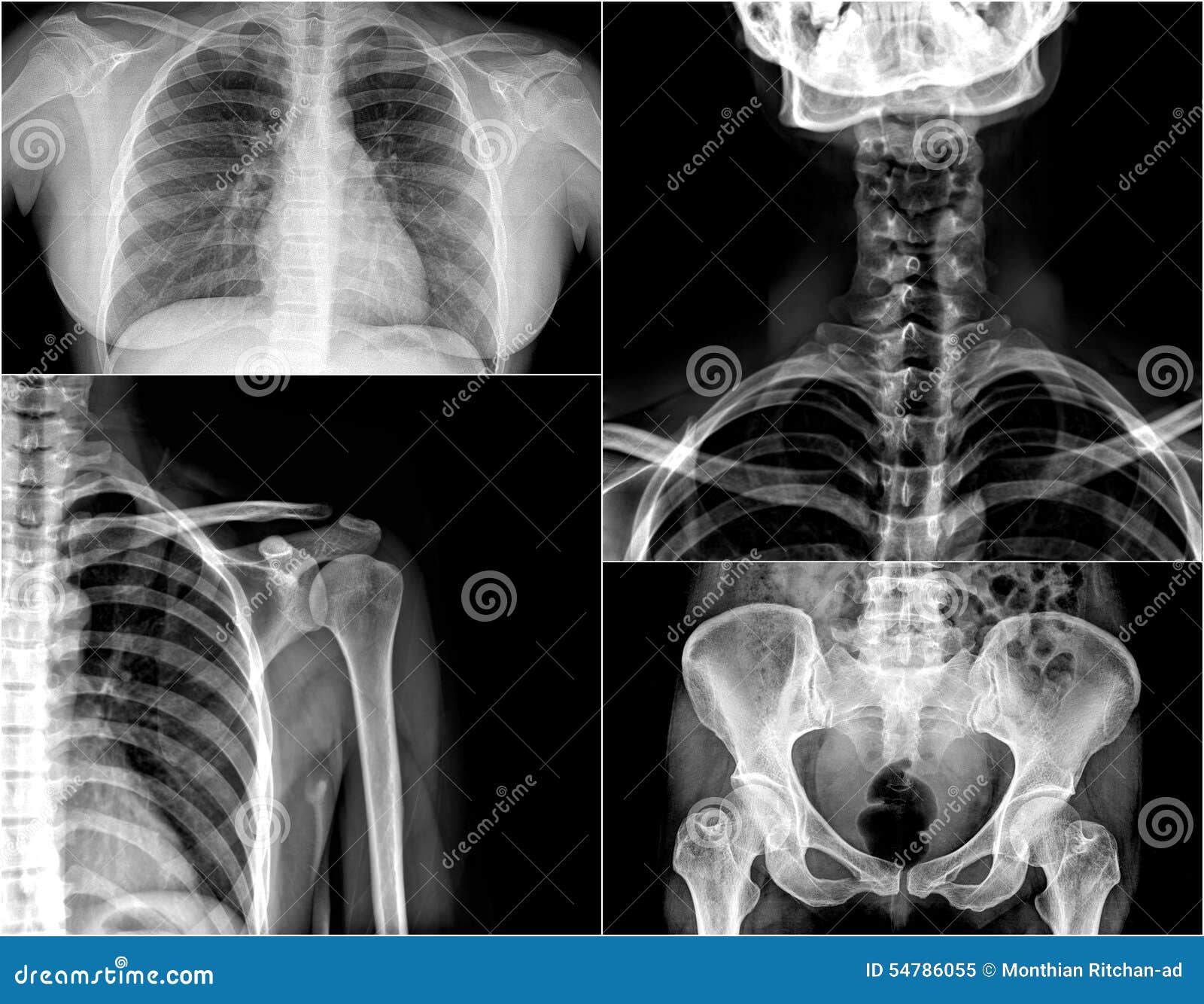 Collection X-ray Multiple Bone Fracture Royalty-Free Stock Photo ...