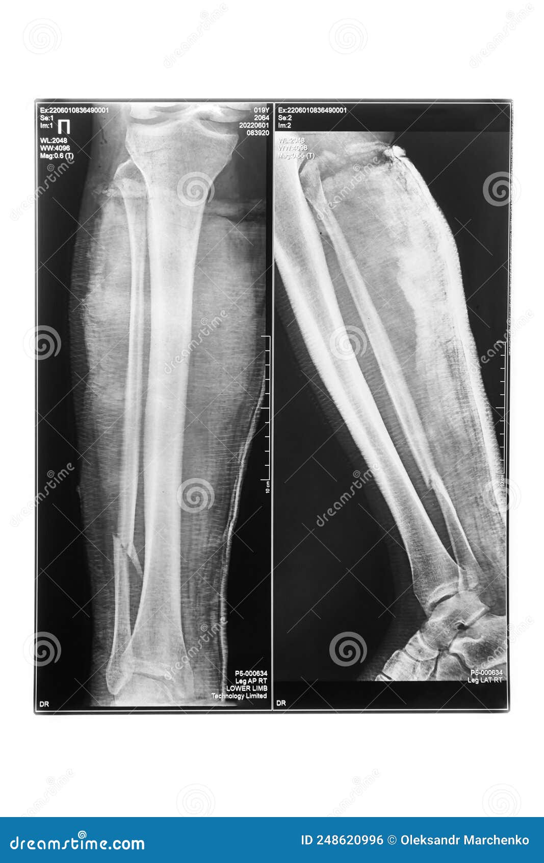 Comminuted Fracture X Ray Comminuted Fracture X Ray