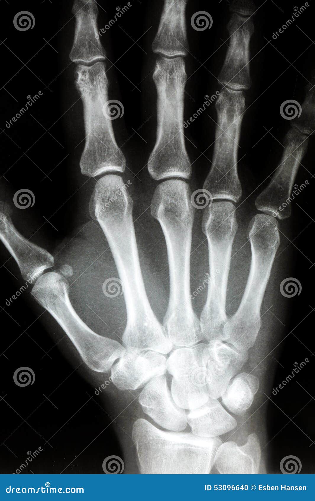 X Ray de la mano derecha foto de archivo. Imagen de radio - 53096640