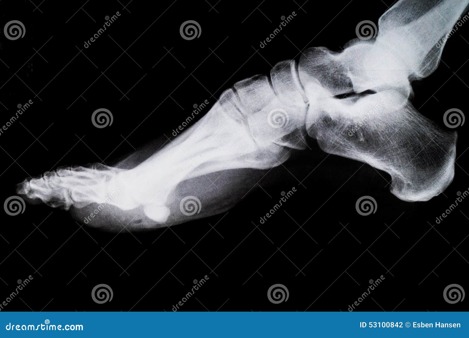 X Ray del pie foto de archivo. Imagen de esqueleto, salud - 53100842