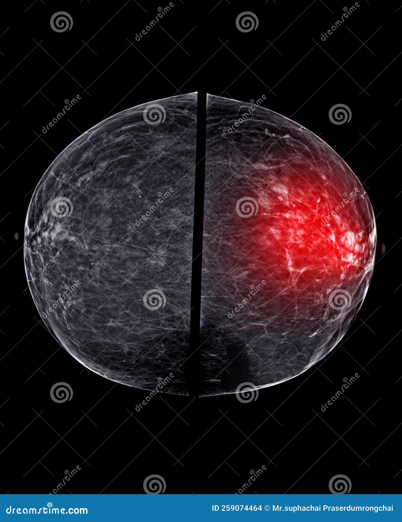 X Ray Digital Mammogram Or Mammography Of Both Side Breast Standard
