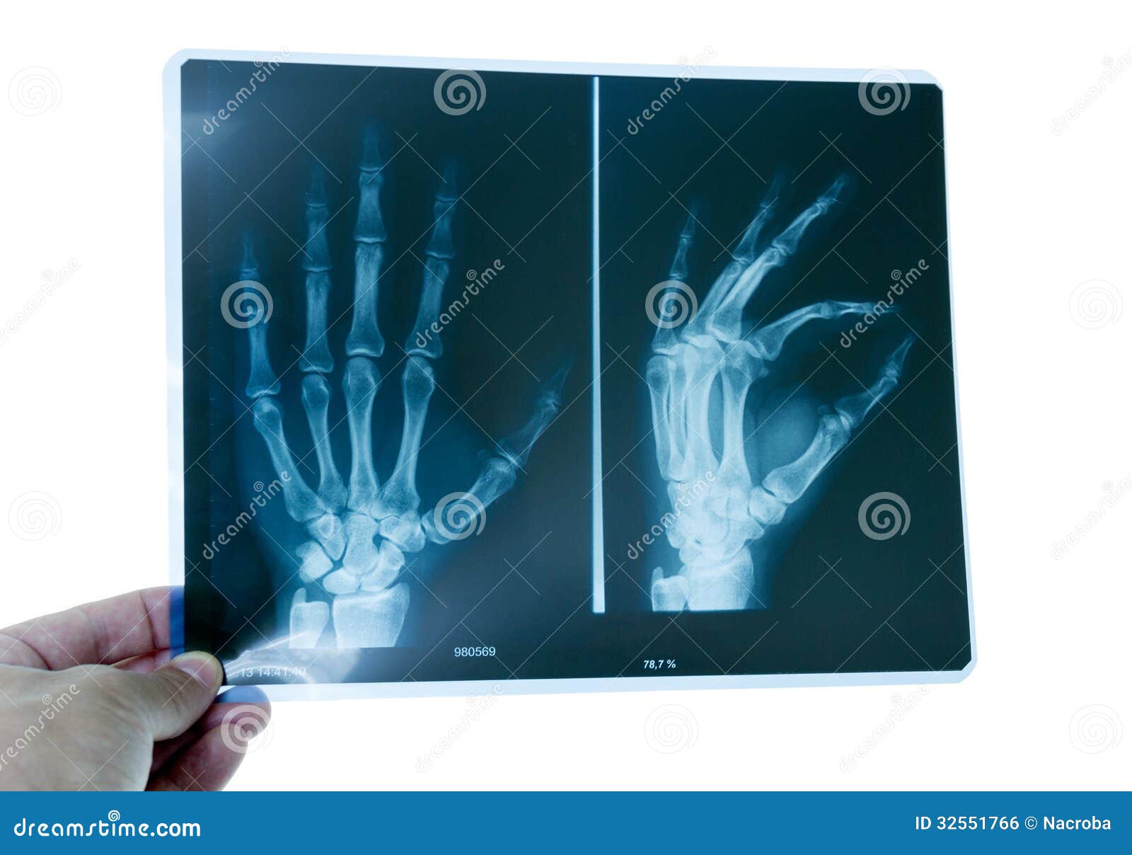 X-ray stock photo. Image of finger, radiologist, people - 32551766