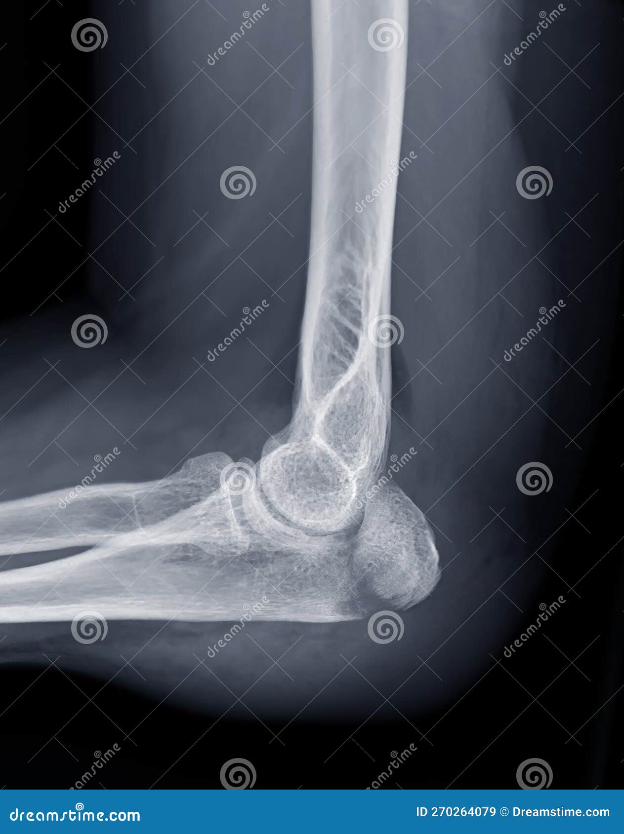 X-ray of Elbow Join Showing Fracture of Ulna Bone Stock Image - Image ...