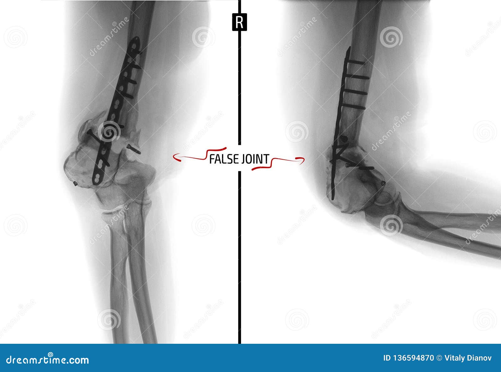 X-ray of the Elbow Joint. False Joint. Negative. Marker Stock Photo ...