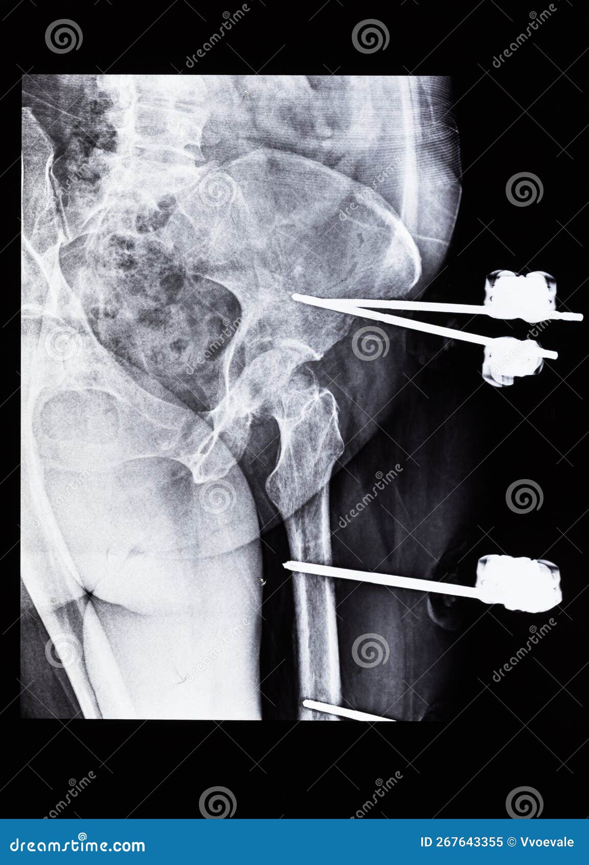 X-ray with External Fixation Device Fixed in Bones Stock Image - Image ...