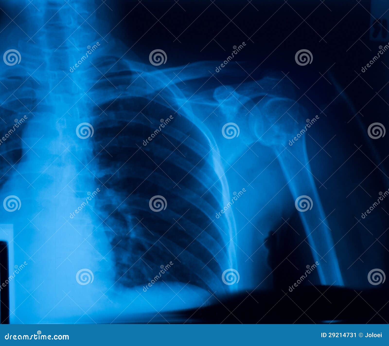 X-ray film stock image. Image of body, science, shoulder - 29214731