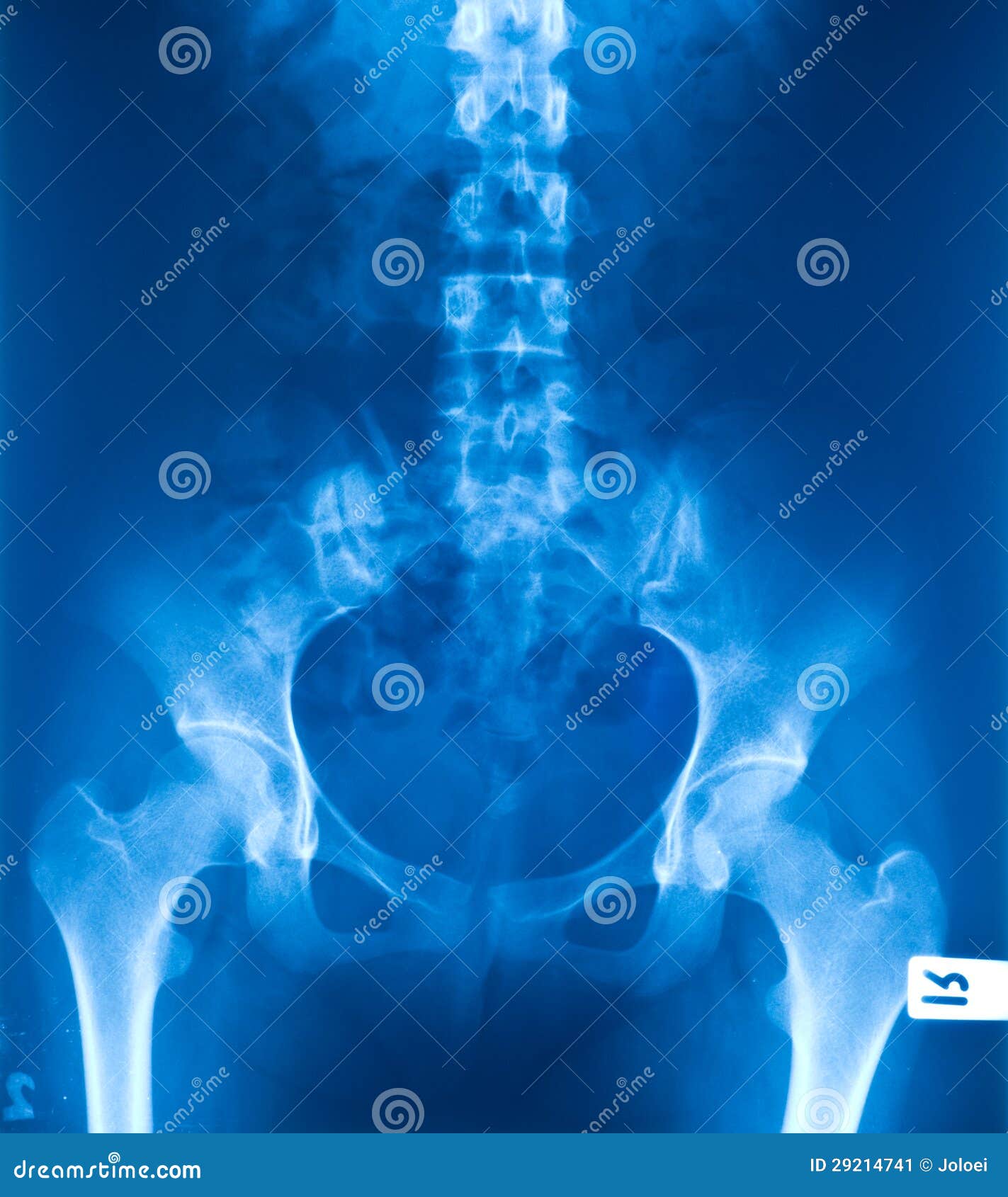 X-ray film stock image. Image of disc, examination, back - 29214741