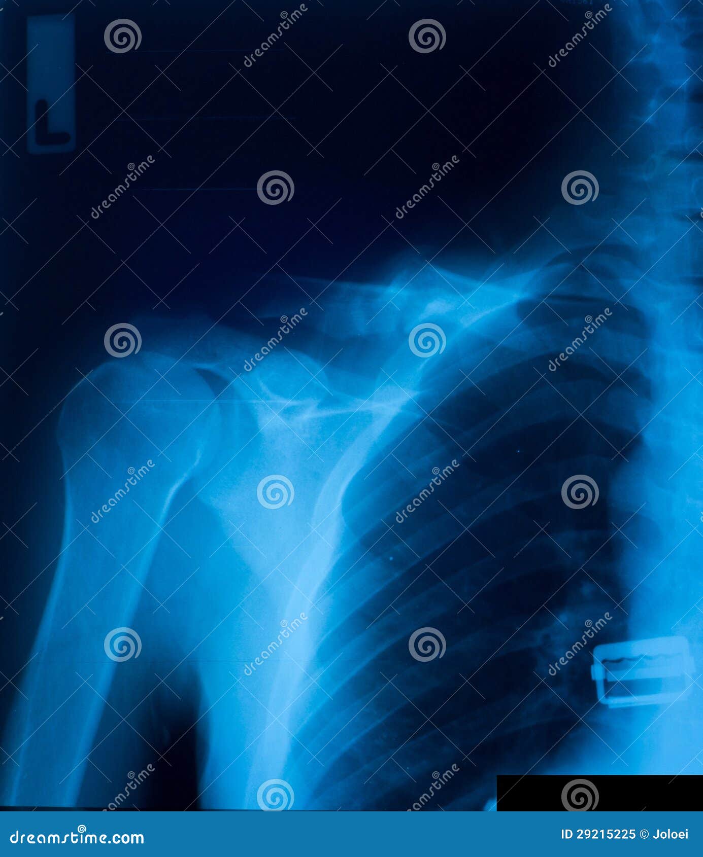 X-ray film stock image. Image of back, break, radiology - 29215225