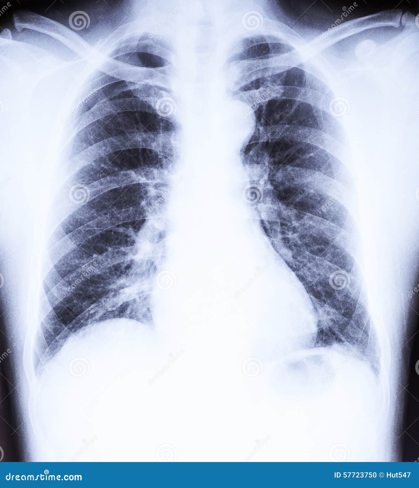 X-Ray Film Dislocation of Shoulder Stock Photo - Image of injury ...