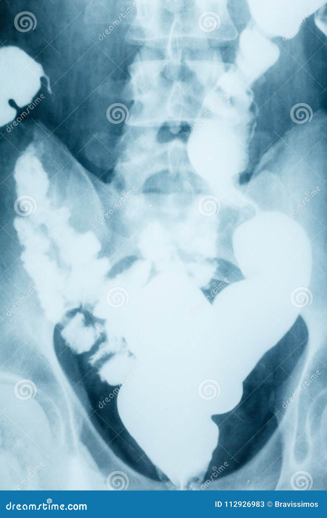 X-ray Image Plain Abdomen , Colon Stock Image - Image of human, abdomen ...