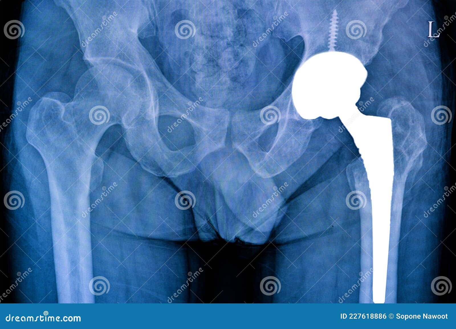 X-ray Film of a Patient with Total Left Hip Replacement Stock Photo ...